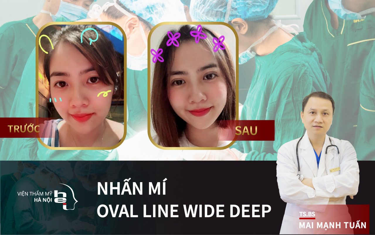 Nhấn mí Oval line - Wide deep - Viện thẩm mỹ Hà Nội